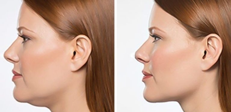 LIPOASPIRAÇAÇÃO SUBMENTONIANA ( LIPO DE PAPADA) - Dra. Tânia Siqueira